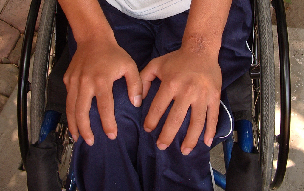 Parálisis cerebral, principal causa de discapacidad motora en niños