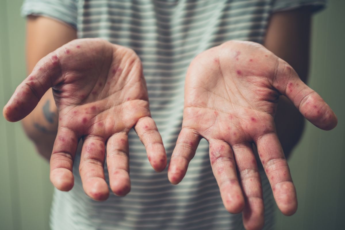 Aumentan casos de Sarampión en México ¿cuántos hay en Querétaro?